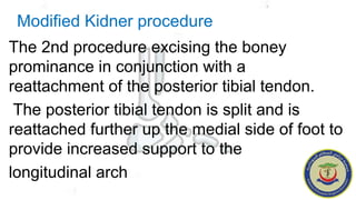painfull accessory navicular bone(1).pptx
