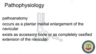 painfull accessory navicular bone(1).pptx