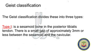 painfull accessory navicular bone(1).pptx