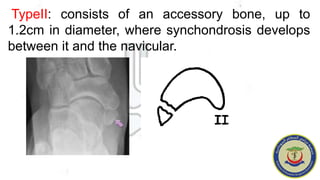 painfull accessory navicular bone(1).pptx