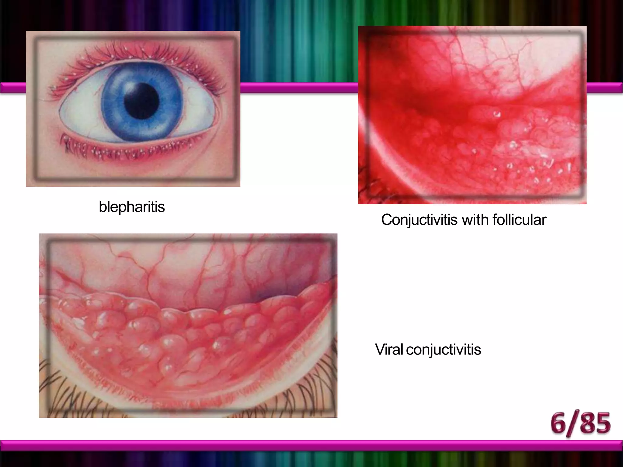 Painful Red Eye Management (1).pptx