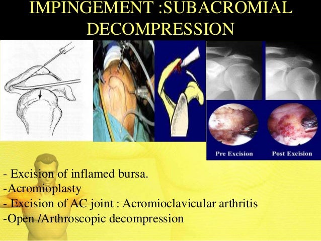 Arthroscopic Subacromial Decompression For Impingement Arthroscopic