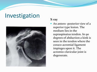Painful shoulder arc | PPTX
