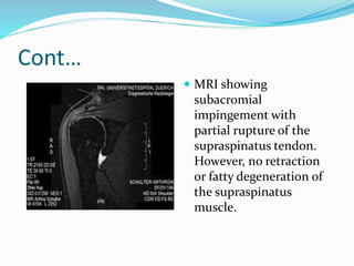 Painful shoulder arc | PPTX