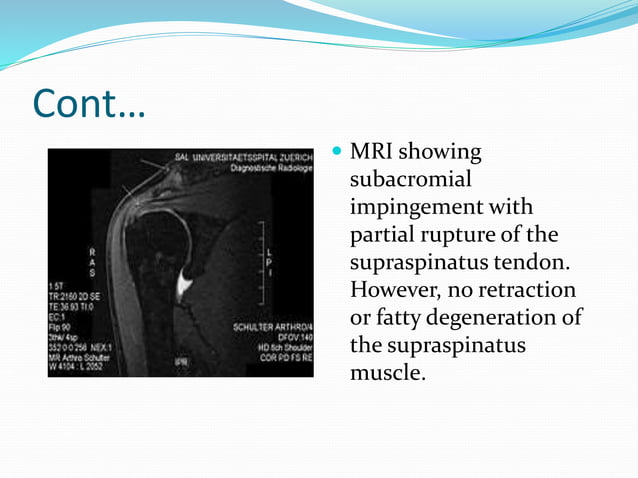 Painful shoulder arc | PPTX