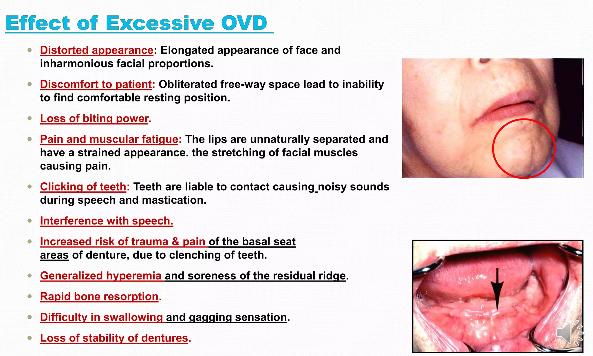 Pain induced from occlusal errors of removable prosthesis | PPTX