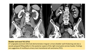 Painless haematuria for P.G Students | PPTX