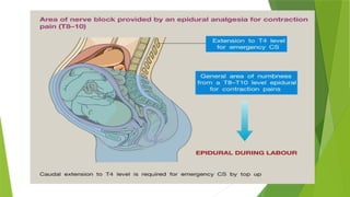 PAINLESS LABOUR- EPIDURAL ANALGESIA-.pptx