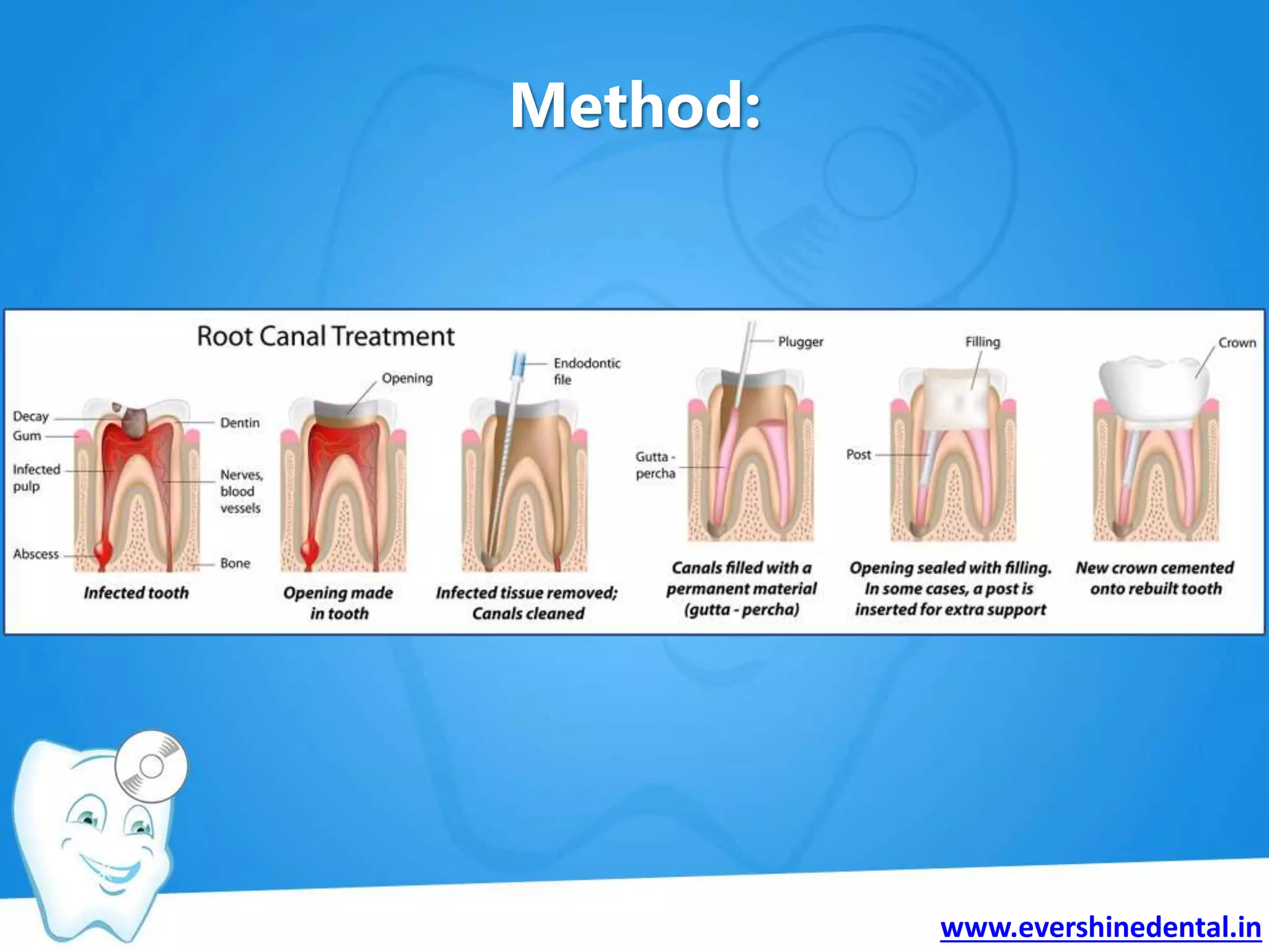 Painless root canal treatment | PPTX