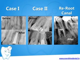 Painless root canal treatment | PPTX