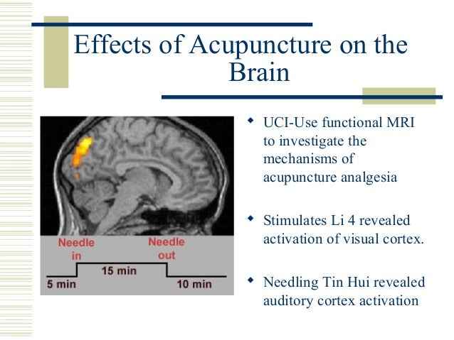 Pain management by acupuncture