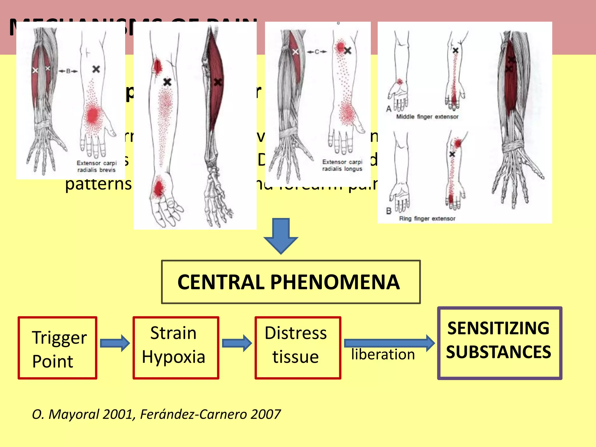 Lateral Epicondylalgia. What do we know about the pain mechanisms? | PDF