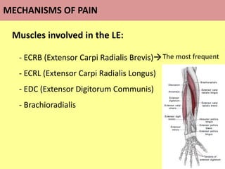 Lateral Epicondylalgia. What do we know about the pain mechanisms? | PDF