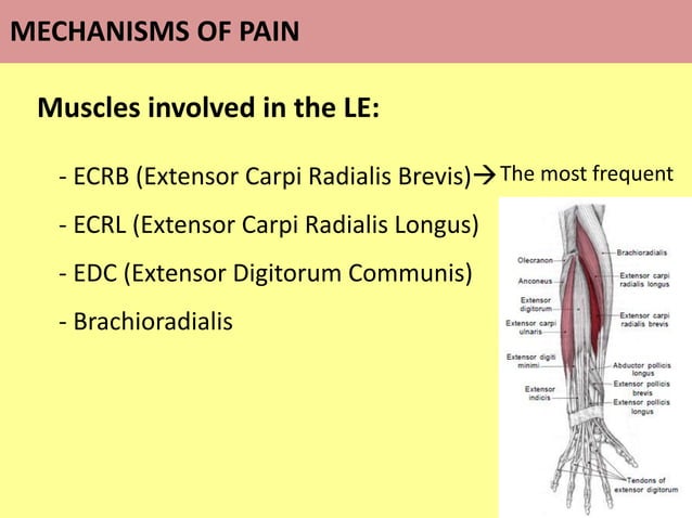 Lateral Epicondylalgia. What do we know about the pain mechanisms? | PDF