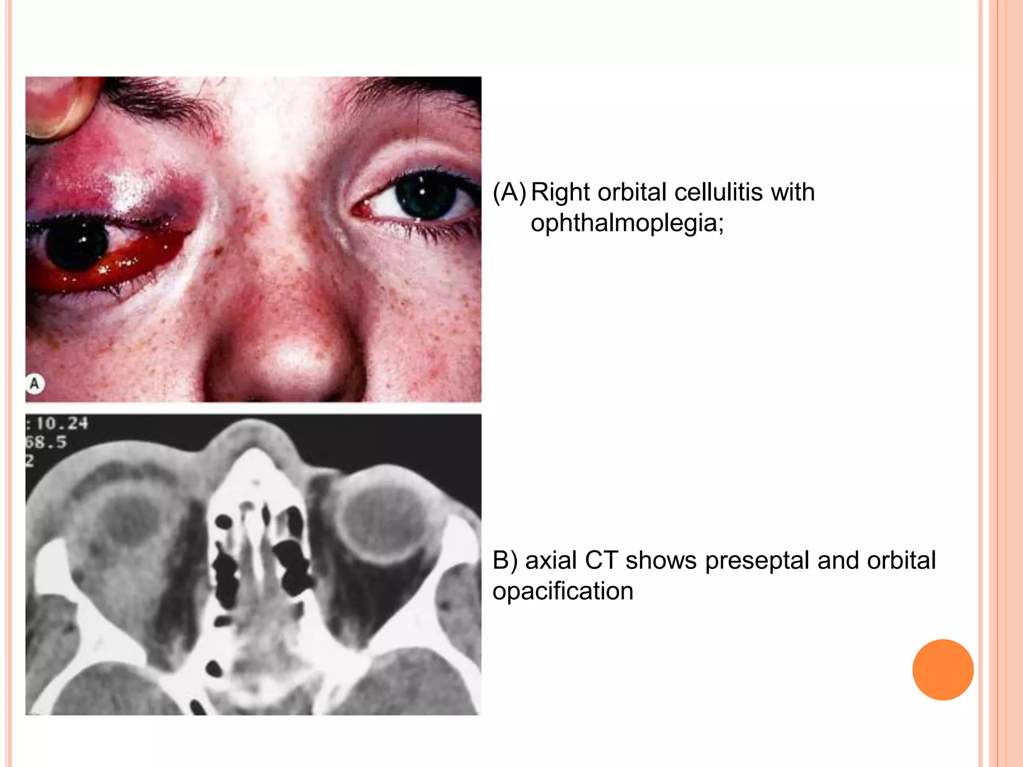 Approach to Pain ophthalmoplegia. | PPTX