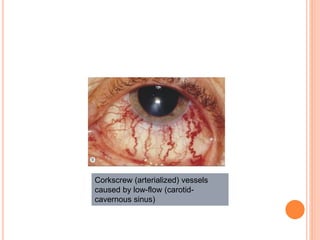 Approach to Pain ophthalmoplegia. | PPTX