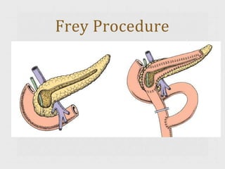 Paithankar Adwait 7610 m2a Chronic Pancreatitis.pptx