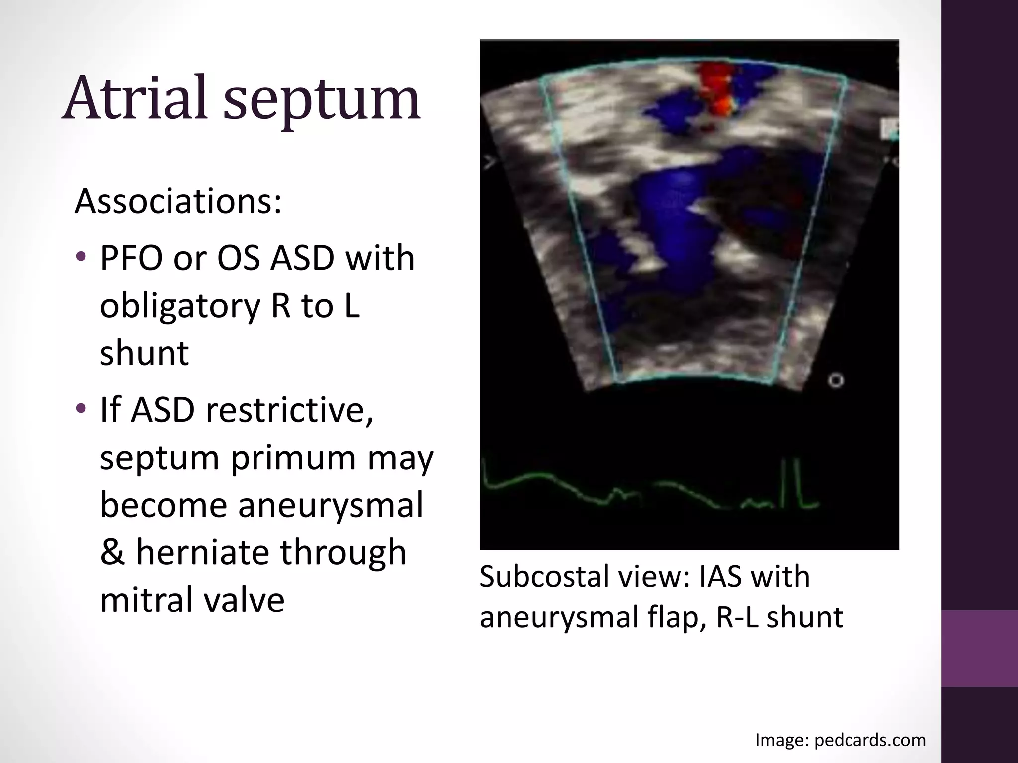 Pulmonary atresia with intact interventricular septum | PPTX