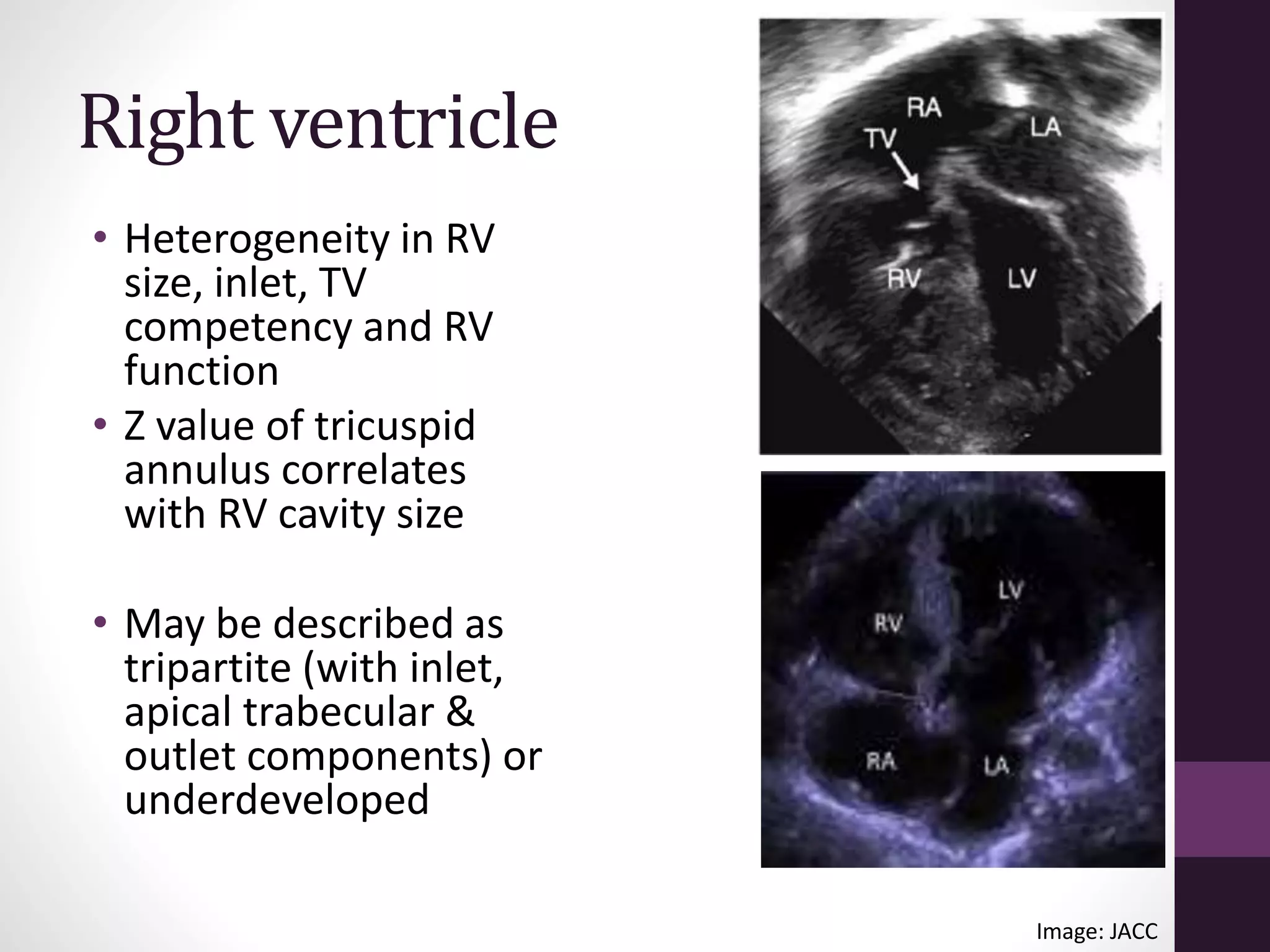 Pulmonary atresia with intact interventricular septum | PPTX