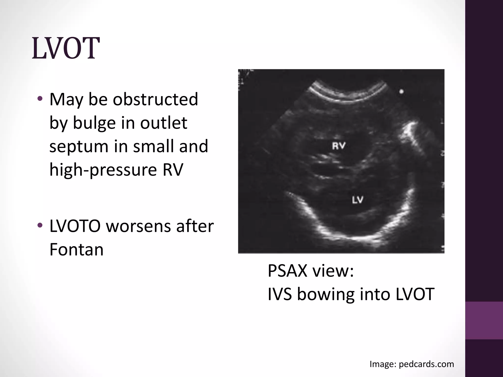 Pulmonary atresia with intact interventricular septum | PPTX