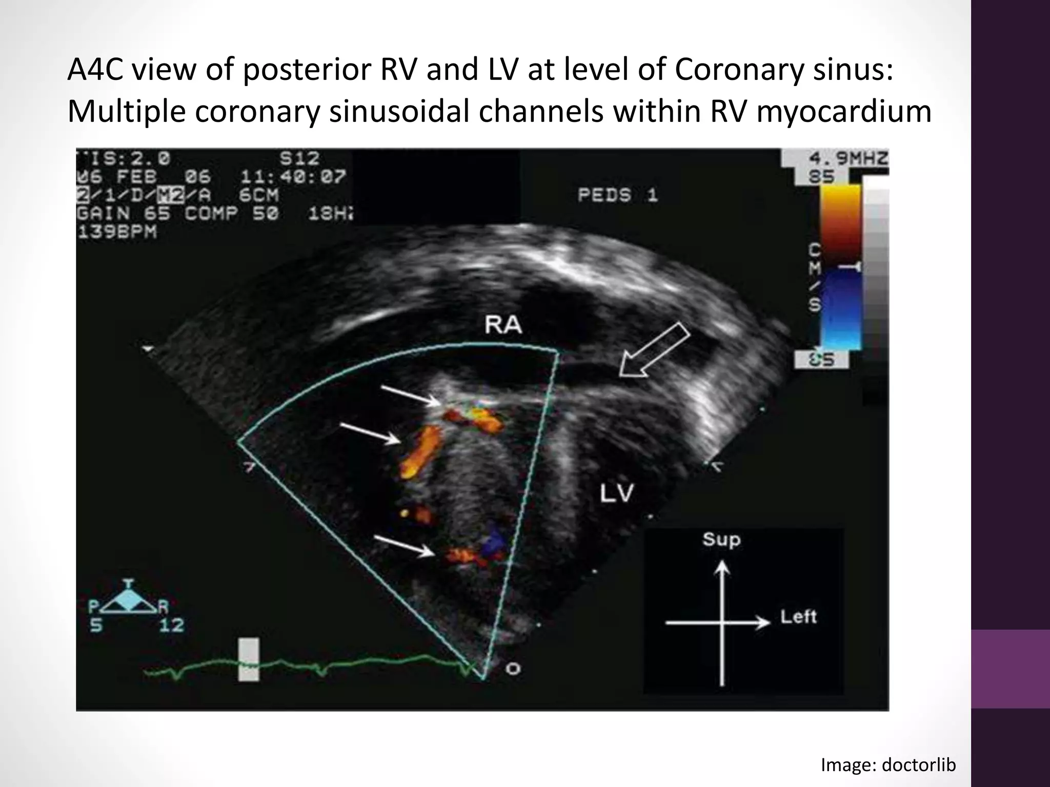 Pulmonary atresia with intact interventricular septum | PPTX