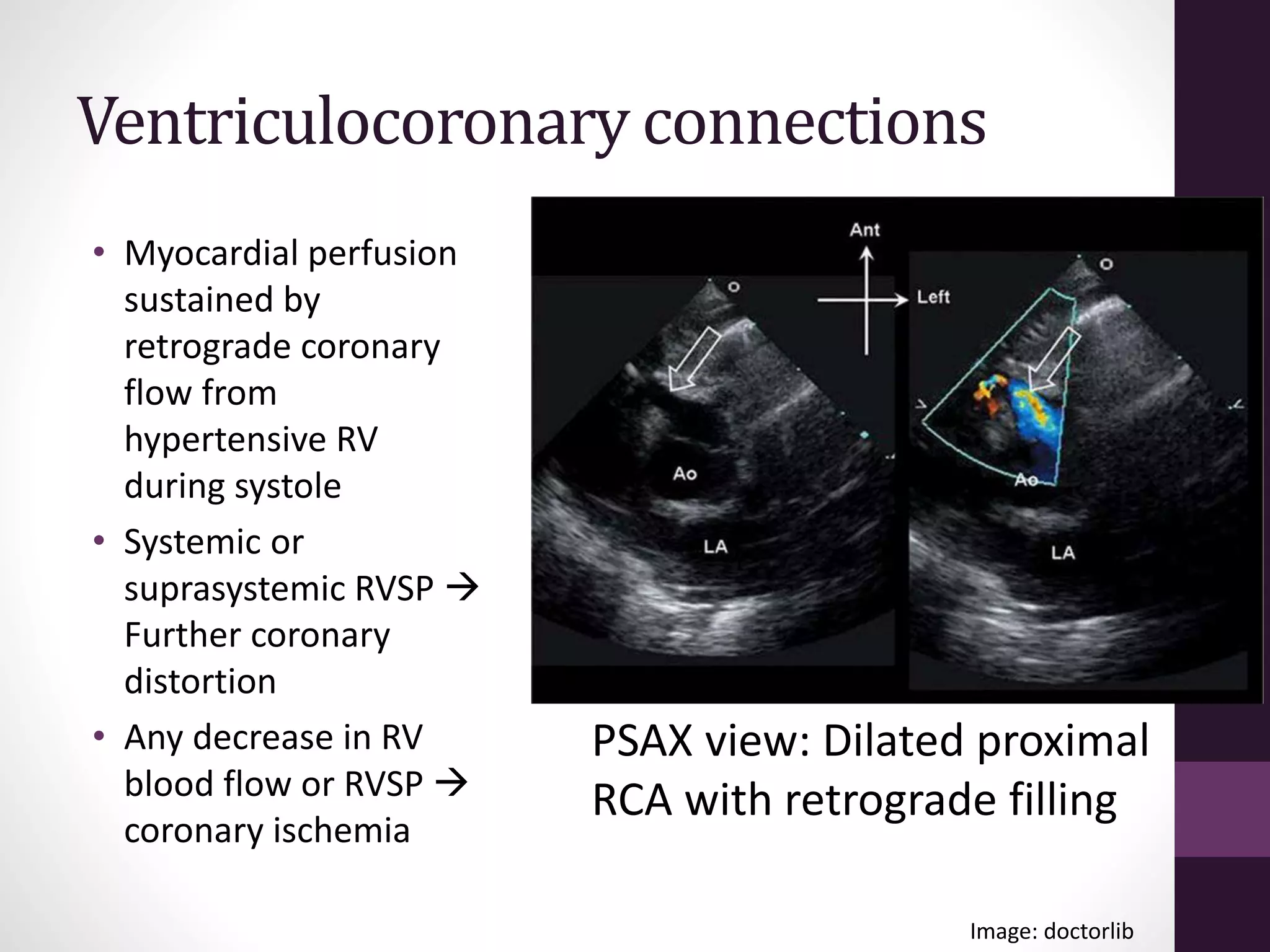 Pulmonary atresia with intact interventricular septum | PPTX