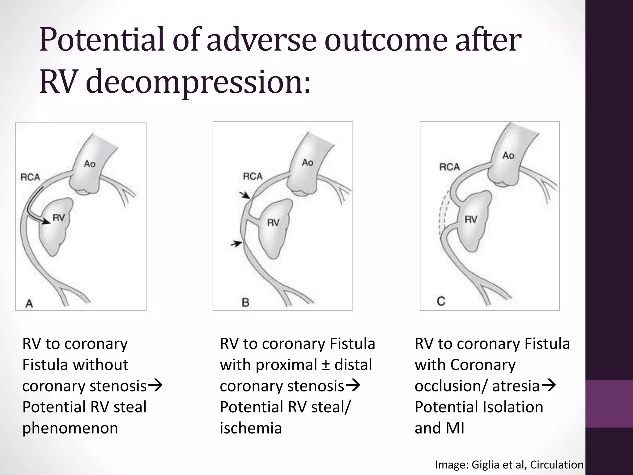 Pulmonary atresia with intact interventricular septum | PPTX