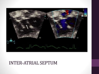 Pulmonary atresia with intact interventricular septum | PPTX