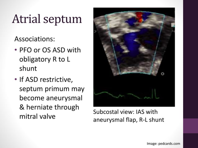 Pulmonary atresia with intact interventricular septum | PPTX