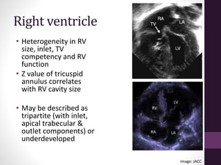 Pulmonary atresia with intact interventricular septum | PPTX