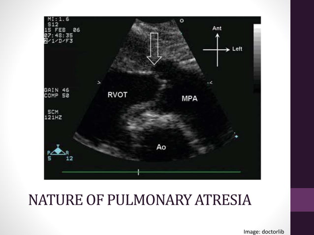 Pulmonary atresia with intact interventricular septum | PPTX