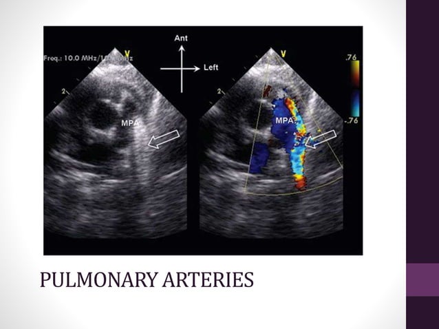 Pulmonary atresia with intact interventricular septum | PPTX