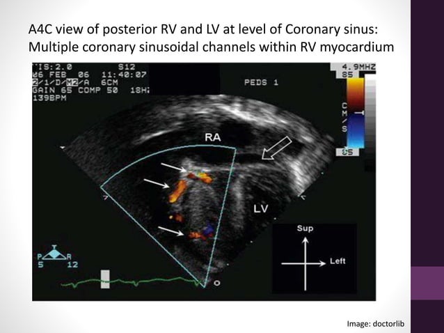 Pulmonary atresia with intact interventricular septum | PPTX