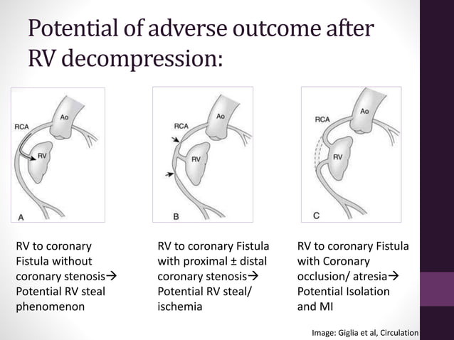 Pulmonary atresia with intact interventricular septum | PPTX