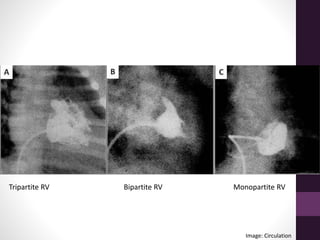 Pulmonary atresia with intact interventricular septum | PPTX