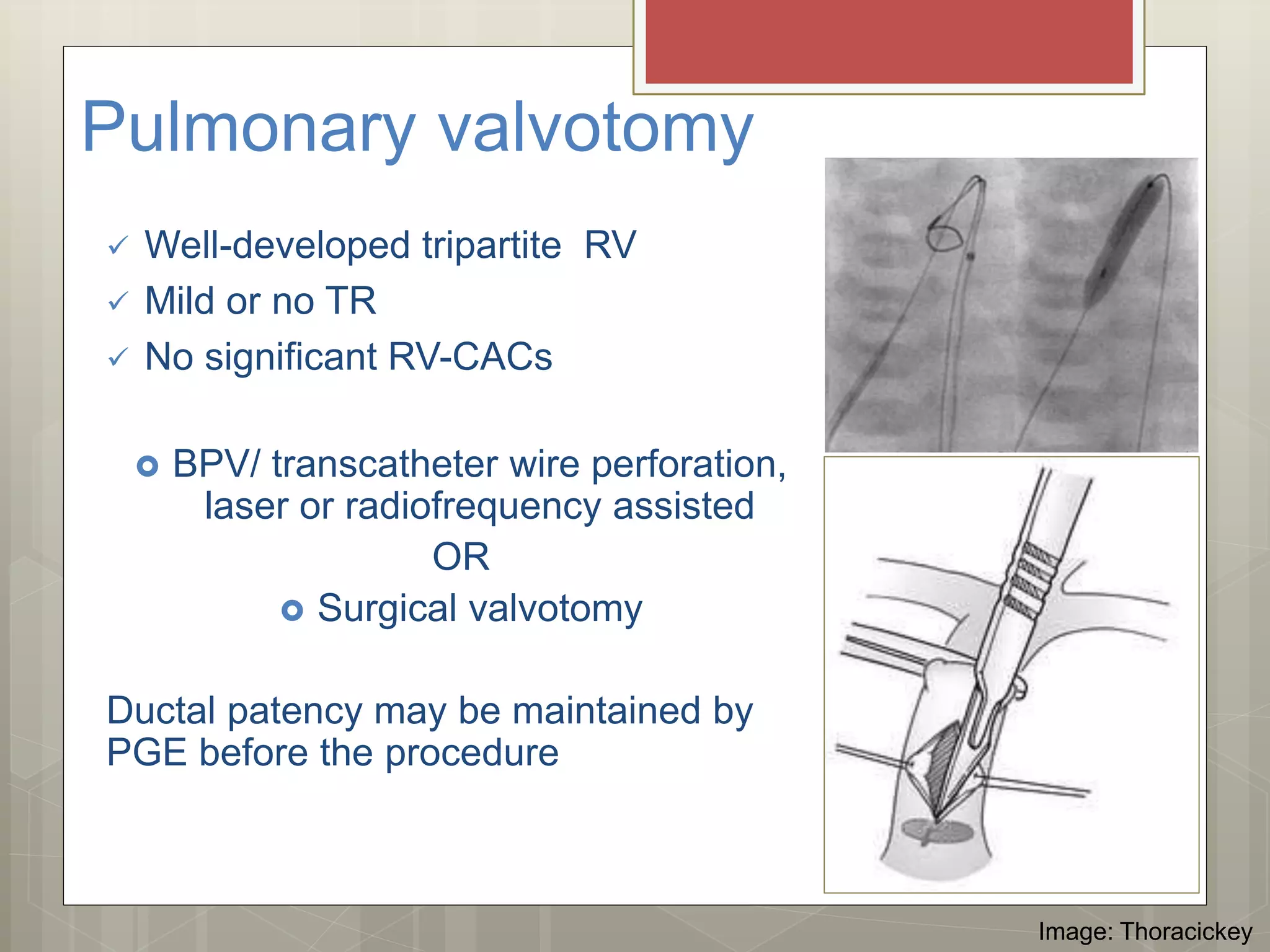 Pulmonary atresia with intact interventricular septum management | PPTX