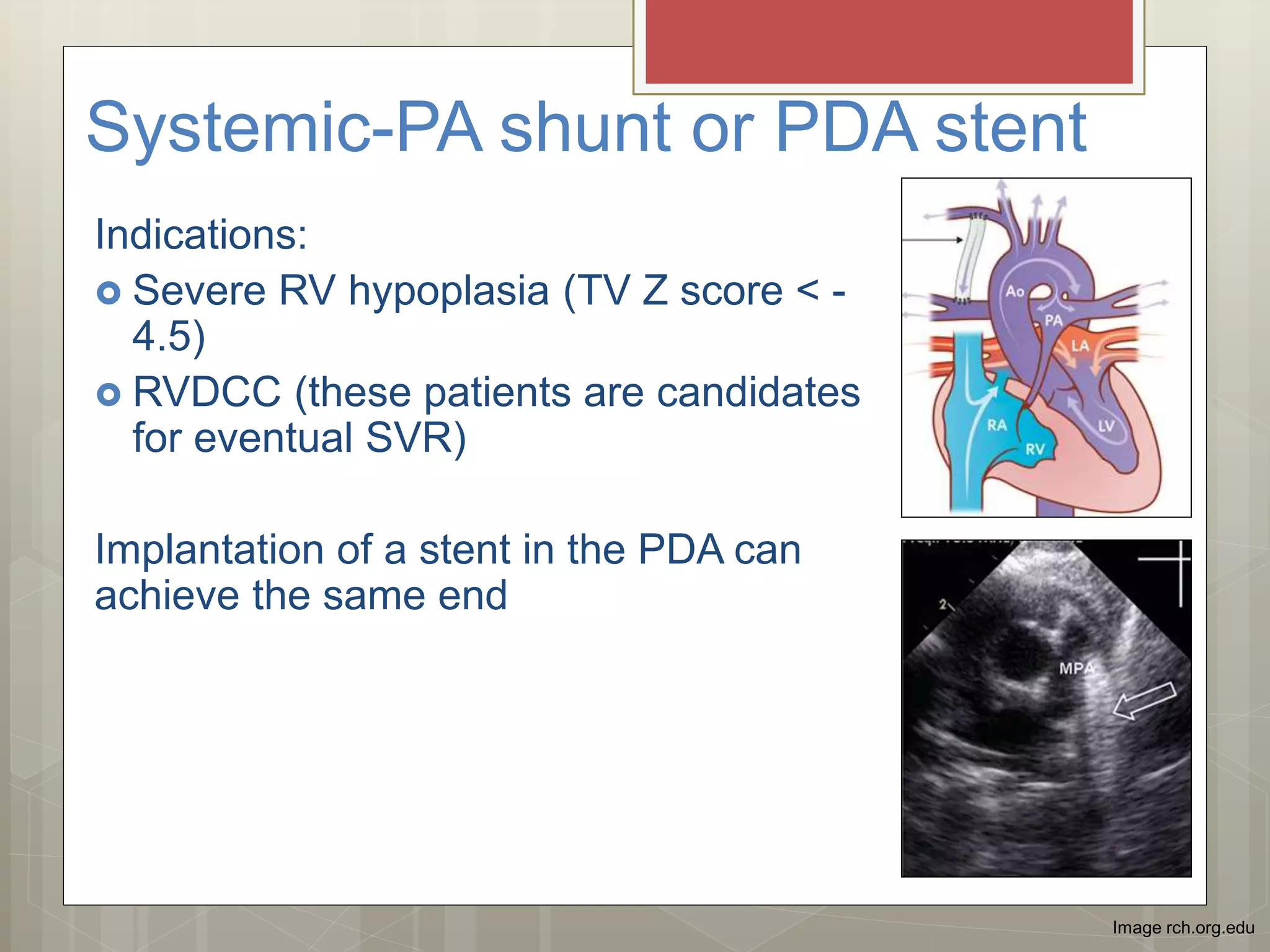 Pulmonary atresia with intact interventricular septum management | PPTX