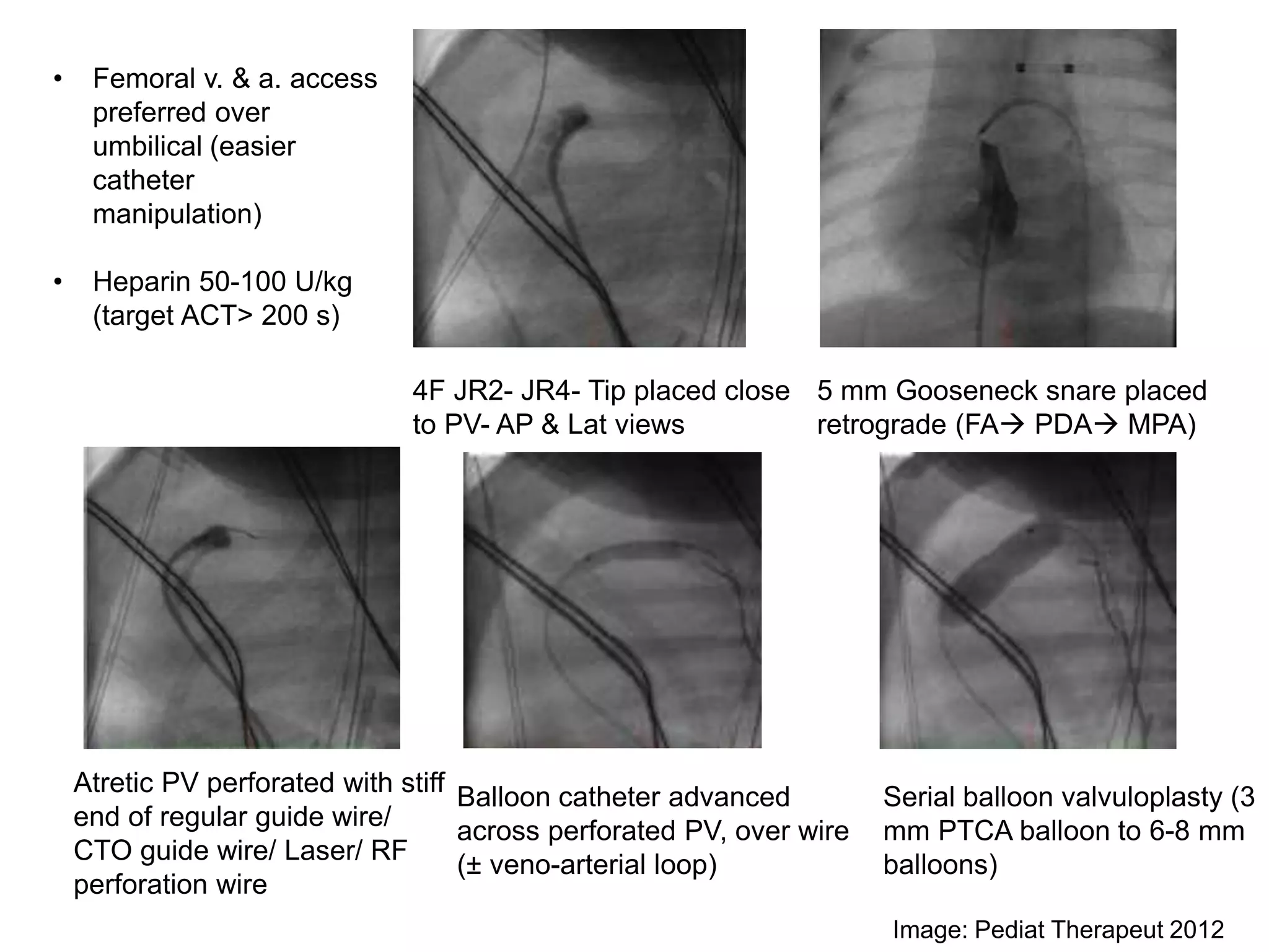 Pulmonary atresia with intact interventricular septum management | PPTX