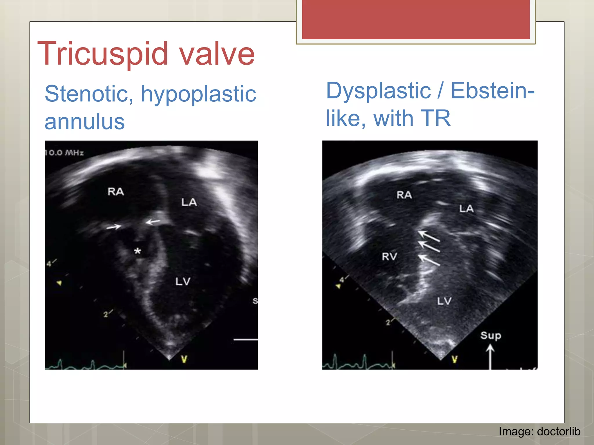 Pulmonary atresia with intact interventricular septum management | PPTX