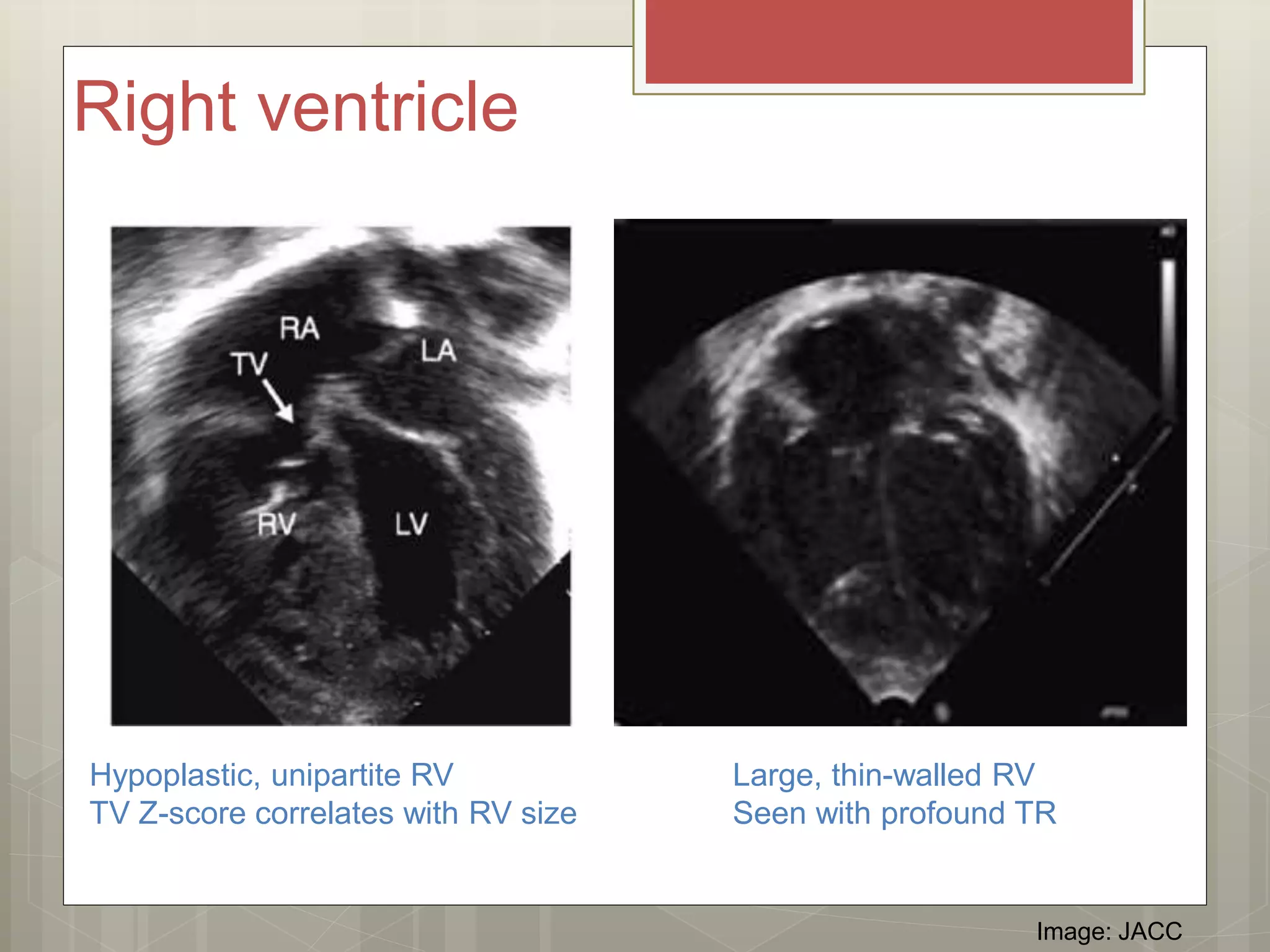 Pulmonary atresia with intact interventricular septum management | PPTX