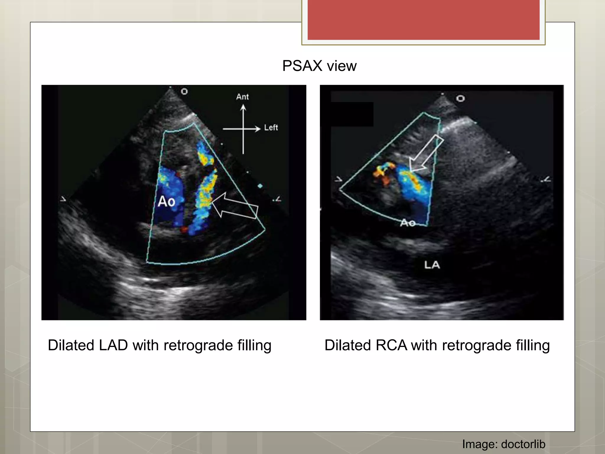 Pulmonary atresia with intact interventricular septum management | PPTX