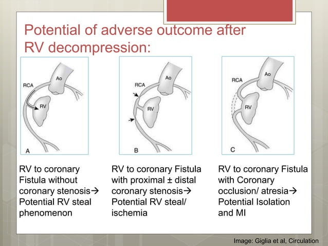 Pulmonary atresia with intact interventricular septum management | PPTX ...