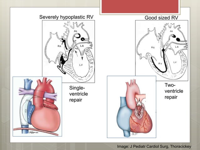 Pulmonary atresia with intact interventricular septum management | PPTX ...