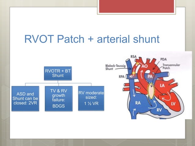 Pulmonary atresia with intact interventricular septum management | PPTX ...