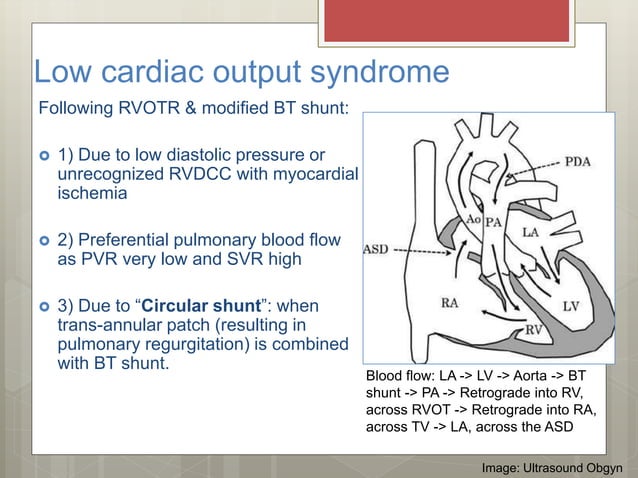 Pulmonary atresia with intact interventricular septum management | PPTX ...