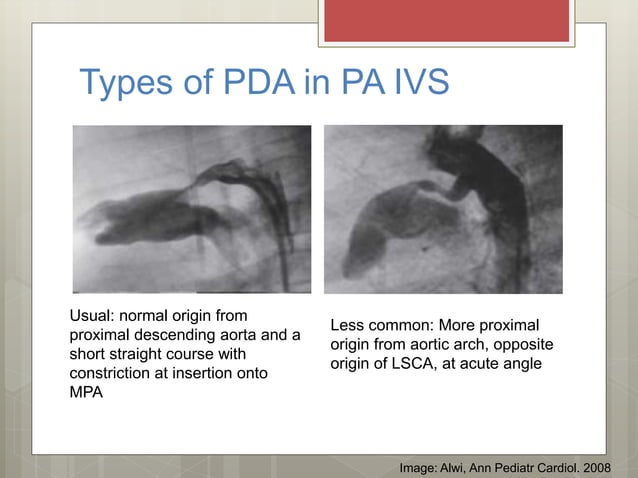 Pulmonary atresia with intact interventricular septum management | PPTX ...