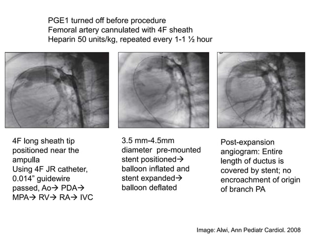 Pulmonary atresia with intact interventricular septum management | PPTX ...