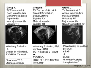 Pulmonary atresia with intact interventricular septum management | PPTX
