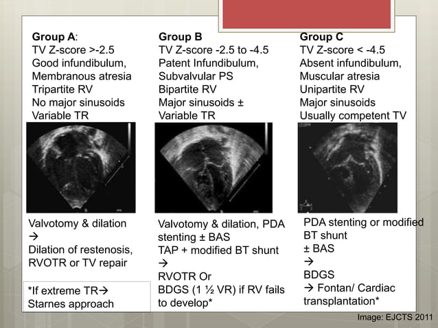 Pulmonary atresia with intact interventricular septum management | PPTX ...