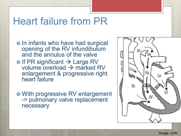 Pulmonary atresia with intact interventricular septum management | PPTX ...